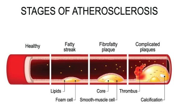 Atherosclerosis - TikvaDrink